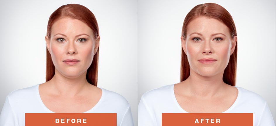 Kybella | Double Chin Treatment | Olympia WA | Tacoma