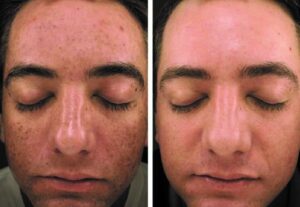 Microneedling Lacey WA | Dermarolling Seattle | Medical Spa WA